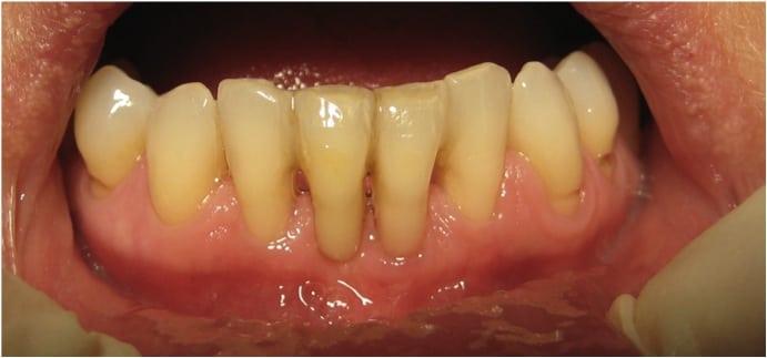 What is Periodontal Disease and What Your Periodontist Wants You to ...